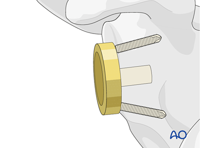 Shoulder implant configurations