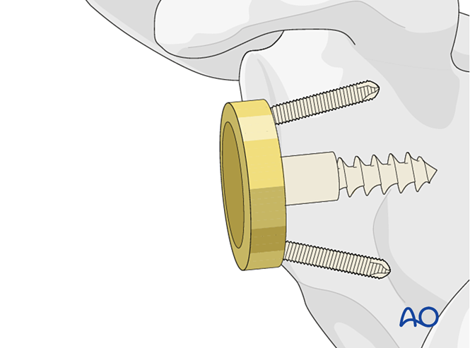Shoulder implant configurations