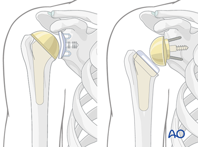 Shoulder implant configurations