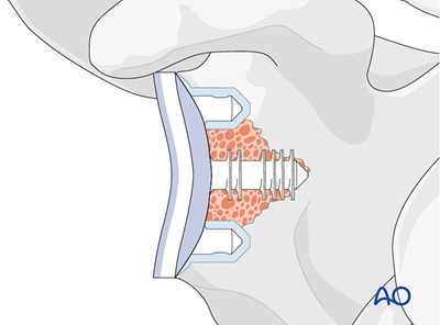 Shoulder implant configurations