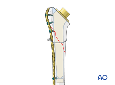 Basic technique – cemented stem