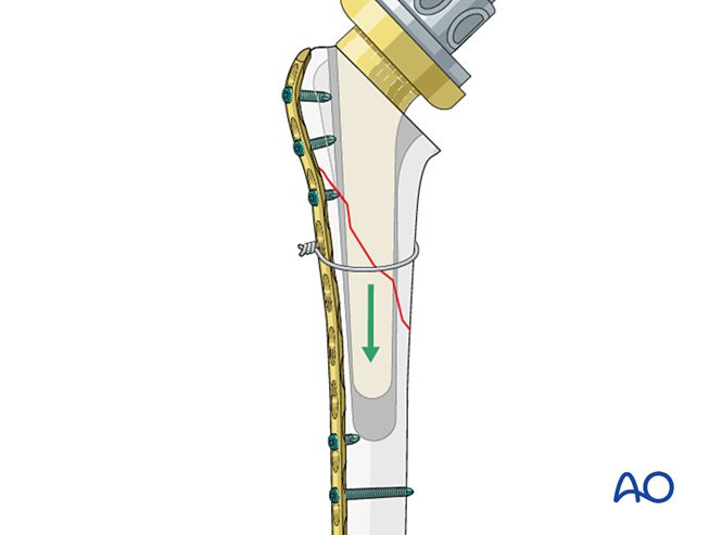 Basic technique – uncemented stem