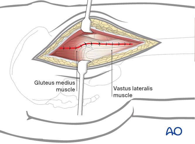 Direct lateral approach to the proximal femur