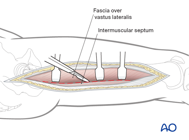 Lateral approach to the femur shaft