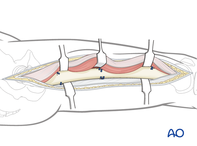 Lateral approach to the femur shaft