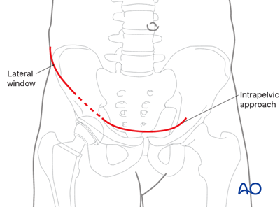 Anterior intrapelvic approach to the acetabulum
