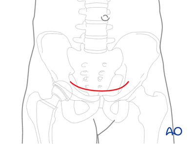 Anterior intrapelvic approach to the acetabulum