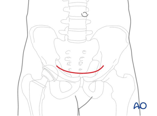 Anterior intrapelvic approach to the acetabulum