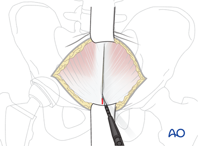 Anterior intrapelvic approach to the acetabulum