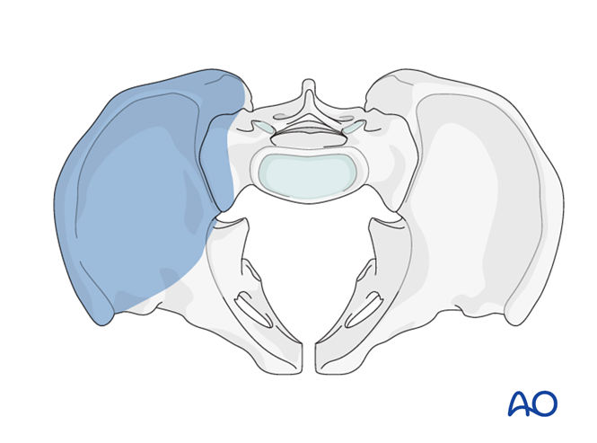 Anterior intrapelvic approach to the acetabulum