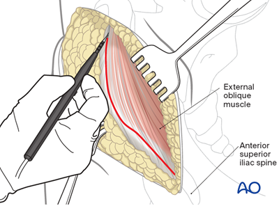 Anterior Superior Iliac Spine (ASIS) osteotomy