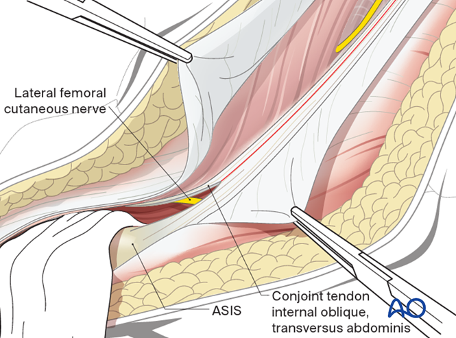 Ilioinguinal approach
