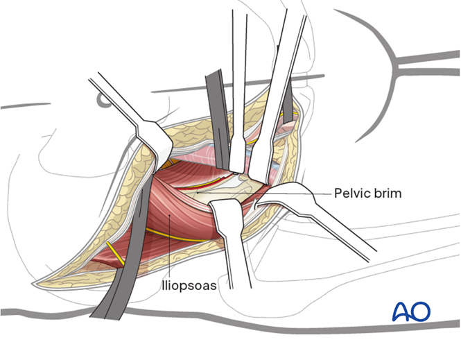 Ilioinguinal approach