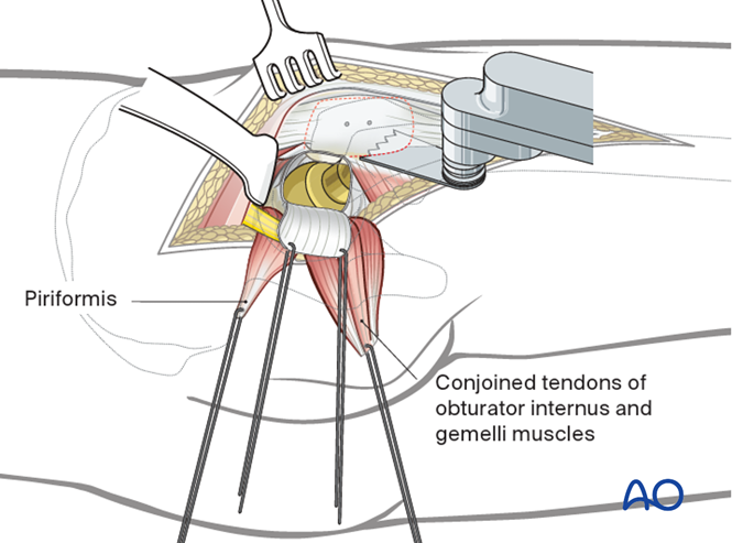 Trochanteric osteotomy