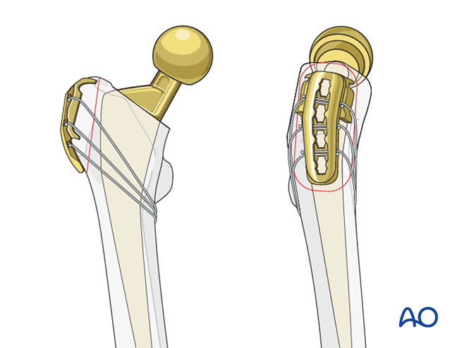 Trochanteric osteotomy
