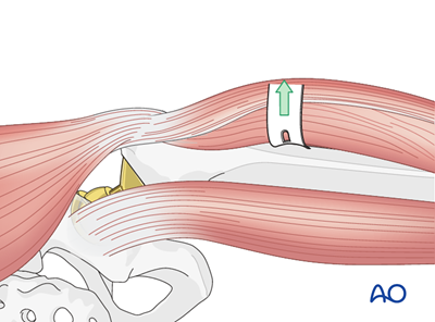 Femur – Extended Trochanteric Osteotomy
