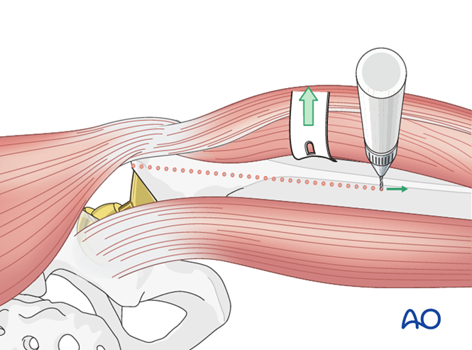 Femur – Extended Trochanteric Osteotomy