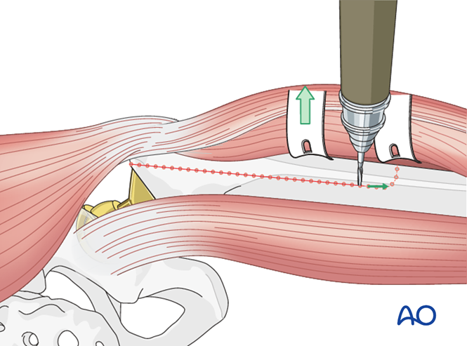 Femur – Extended Trochanteric Osteotomy