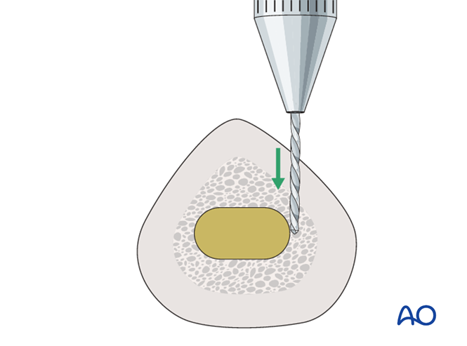 Femur – Extended Trochanteric Osteotomy