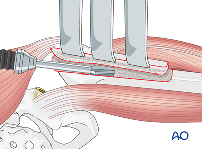 Femur – Extended Trochanteric Osteotomy