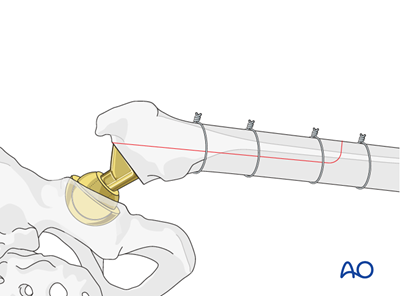 Femur – Extended Trochanteric Osteotomy