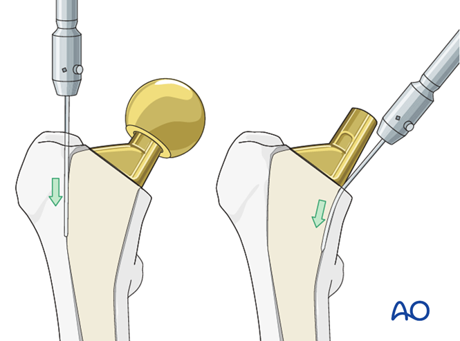 Femoral stem removal