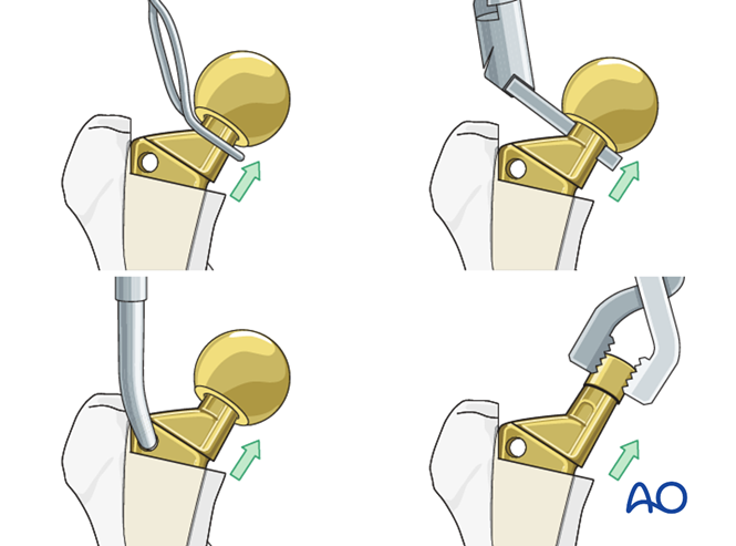 Femoral stem removal