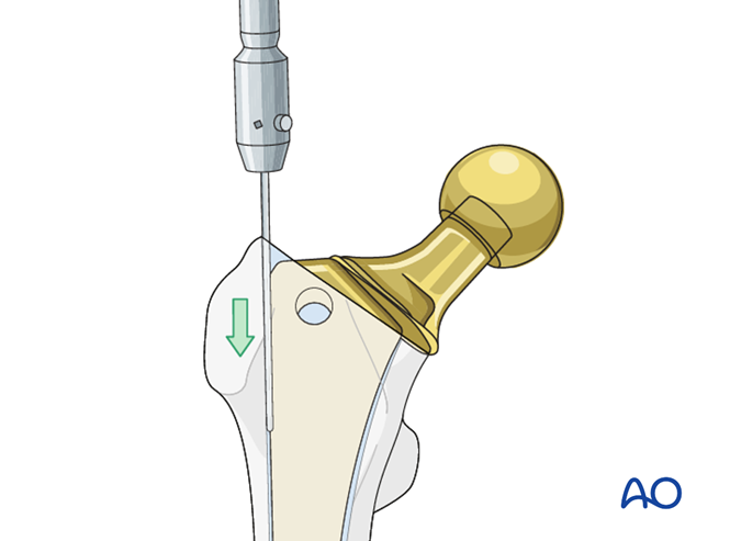 Diaphyseal fixation using long tapered stem for Trochanteric femoral ...
