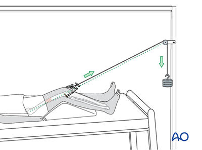 Compression plate and screw fixation for Fracture around the stem with ...