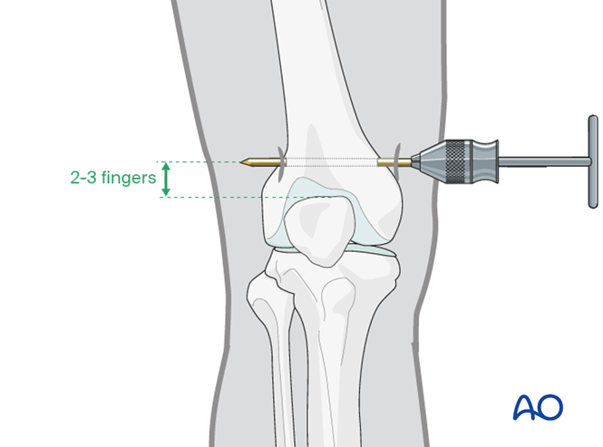 Traction and bed rest for Fracture of the femur distant to the implant
