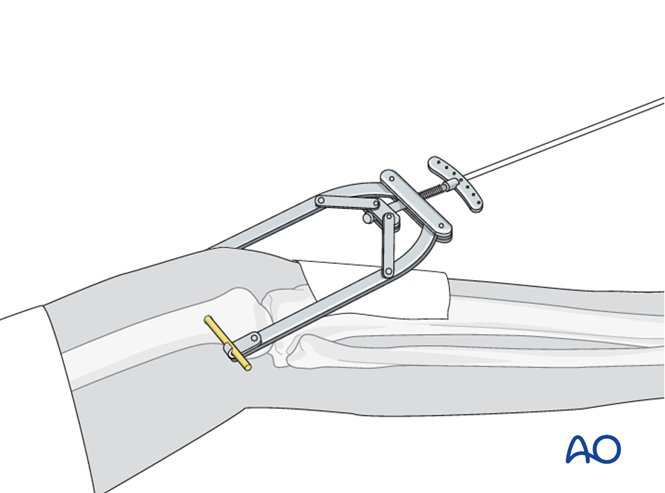Traction and bed rest for Fracture of the femur distant to the implant