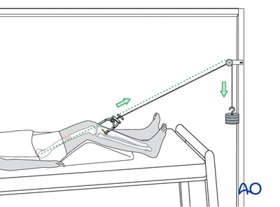 Traction and bed rest for Fracture of the femur distant to the implant