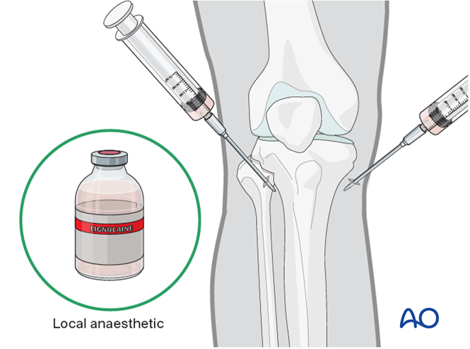Traction and bed rest for Fracture of the femur distant to the implant