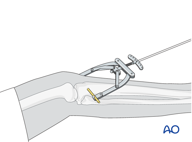 Traction and bed rest for Fracture of the femur distant to the implant