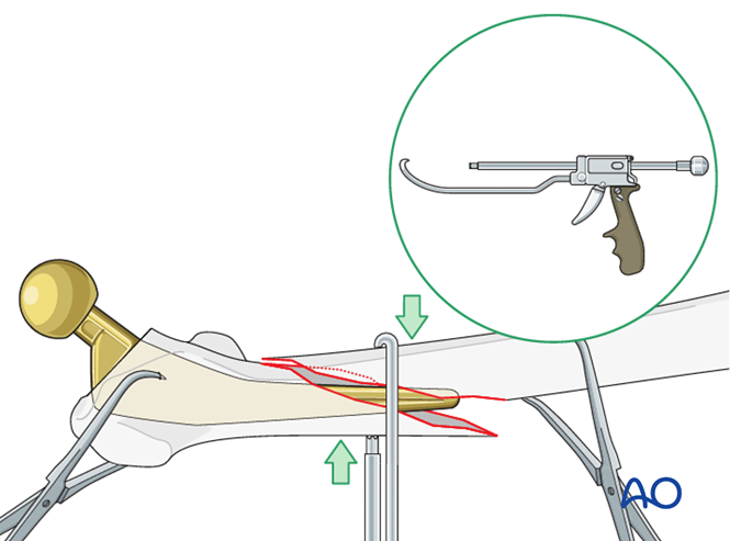 Compression plate and screw fixation for Fracture around the stem with ...