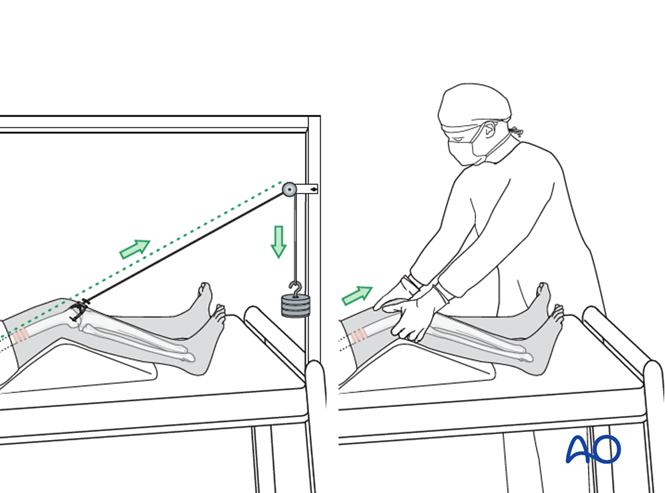 Intramedullary nail and plate fixation for Fracture of the femur ...