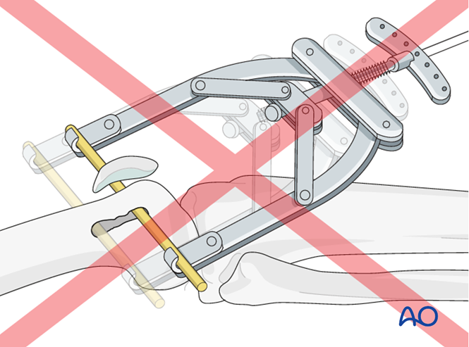 Compression plate and screw fixation for Fracture of the femur distant ...