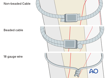 Isolated cerclage for Fracture around the stem with a stable implant ...