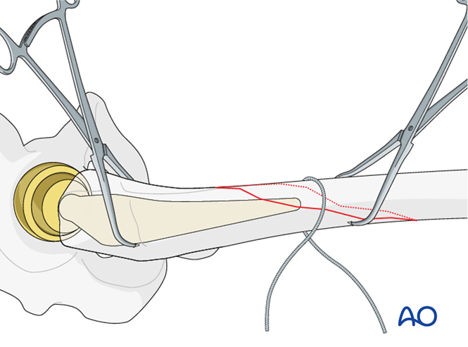 Isolated cerclage for Fracture around the stem with a stable implant ...