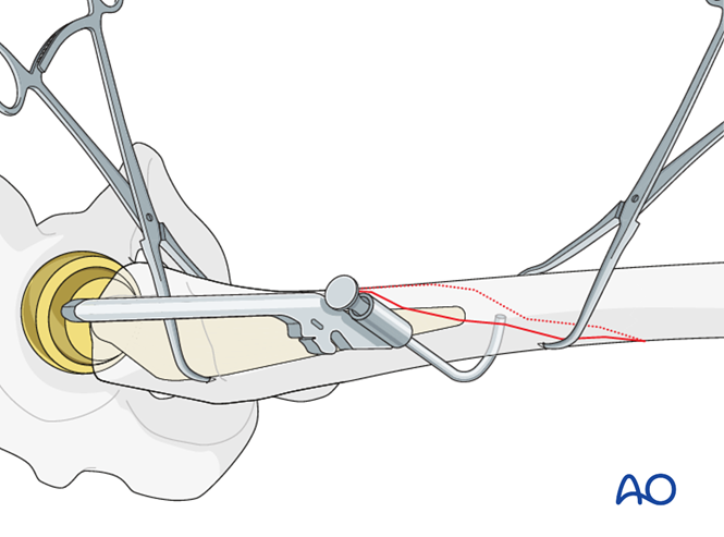 Isolated cerclage for Fracture around the stem with a stable implant ...