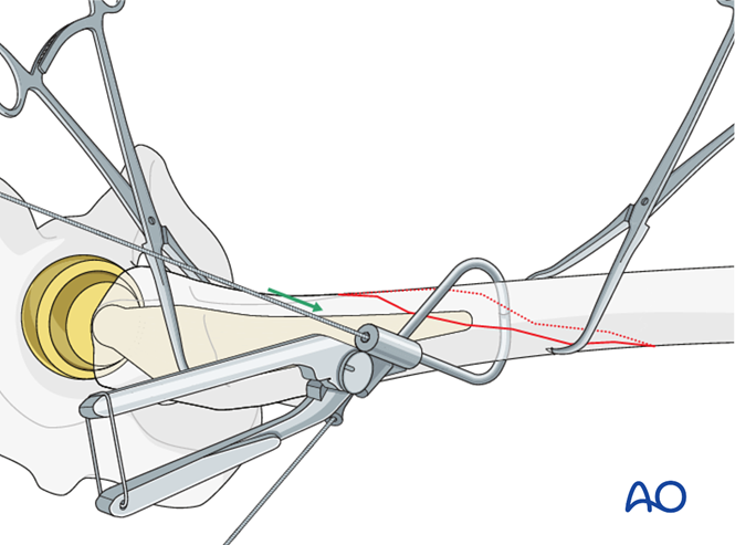 Isolated cerclage for Fracture around the stem with a stable implant ...