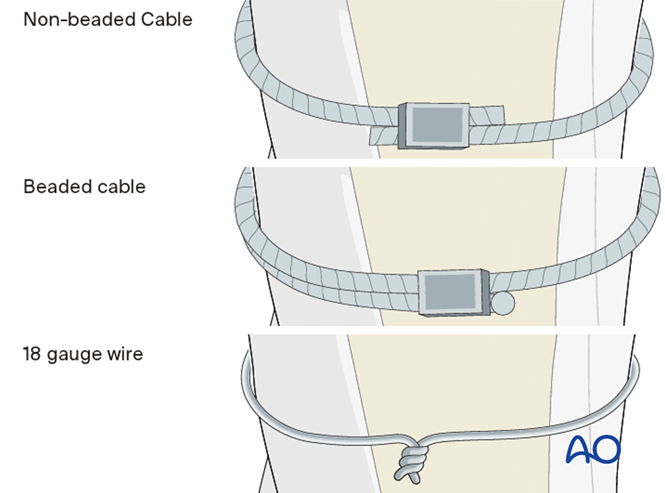 Isolated cerclage for Trochanteric femoral fracture