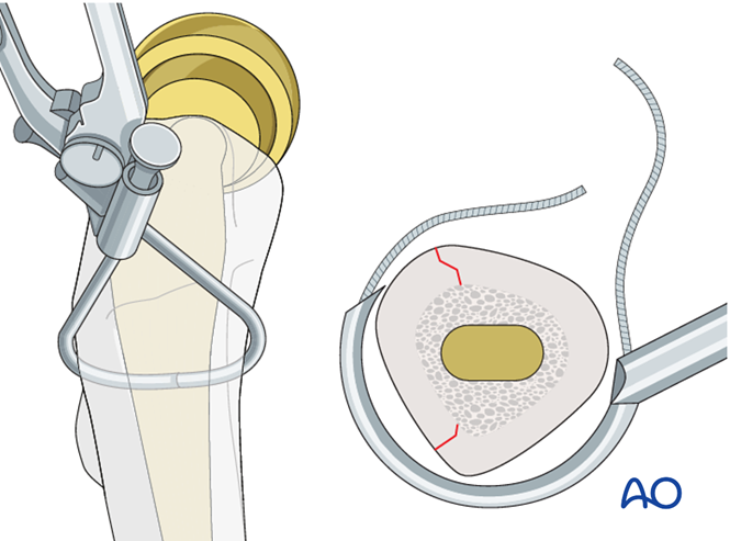 Isolated cerclage for Trochanteric femoral fracture