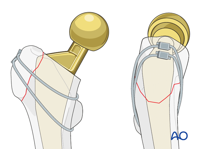 Isolated cerclage for Trochanteric femoral fracture