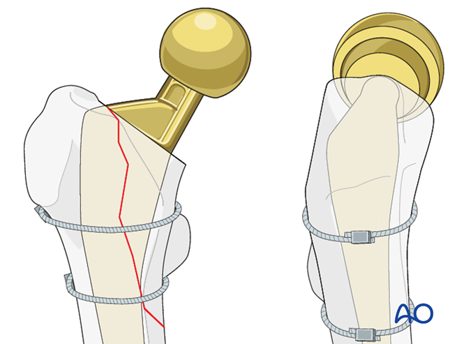 Isolated cerclage for Trochanteric femoral fracture