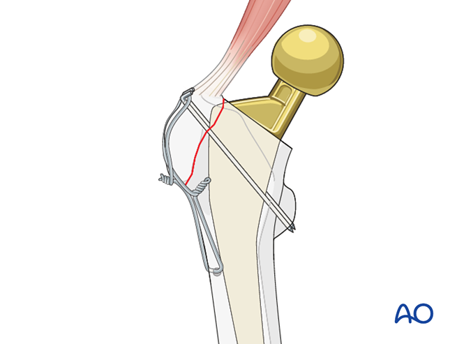 Tension band wiring for Trochanteric femoral fracture