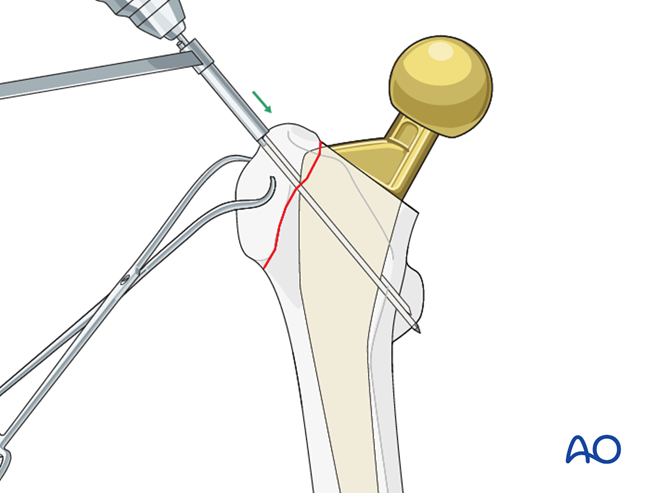 Tension band wiring for Trochanteric femoral fracture