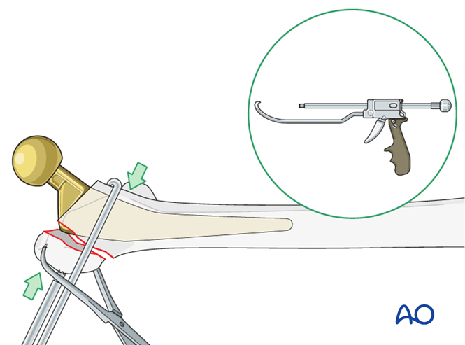 Isolated cerclage for Trochanteric femoral fracture