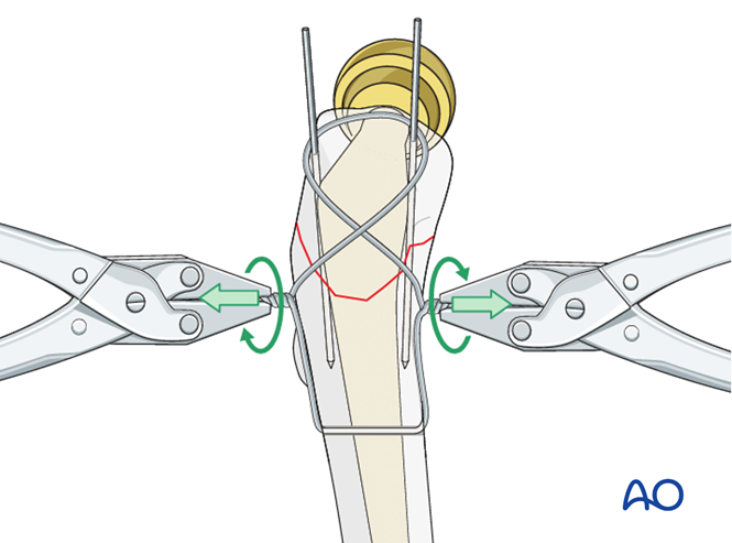 Tension band wiring for Trochanteric femoral fracture