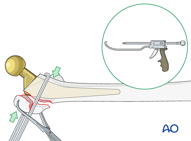 Compression plate and screw fixation for Trochanteric femoral fracture